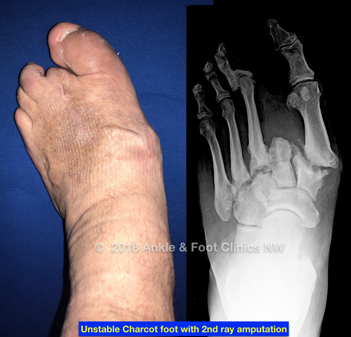 Charcot Disease | Integrative Foot & Ankle Centers of Washington
