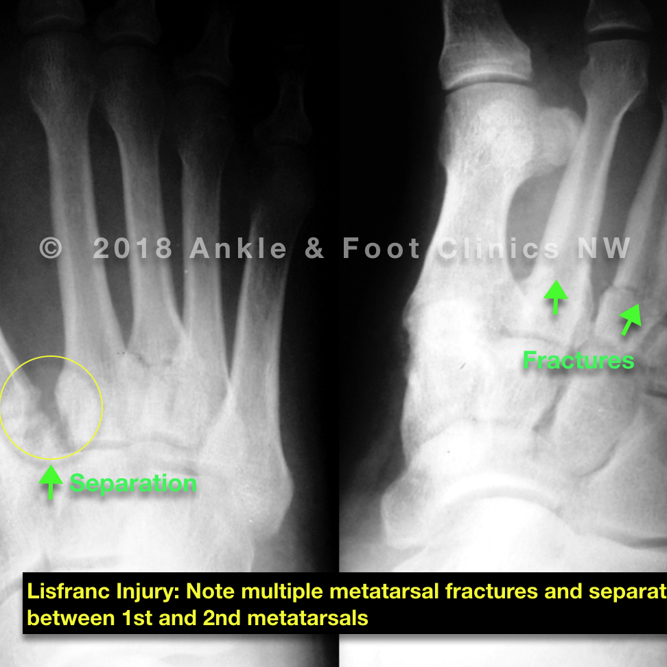 Ankle Dislocation Diagram Dislocated Ankle: Over 190 Royalty Free
