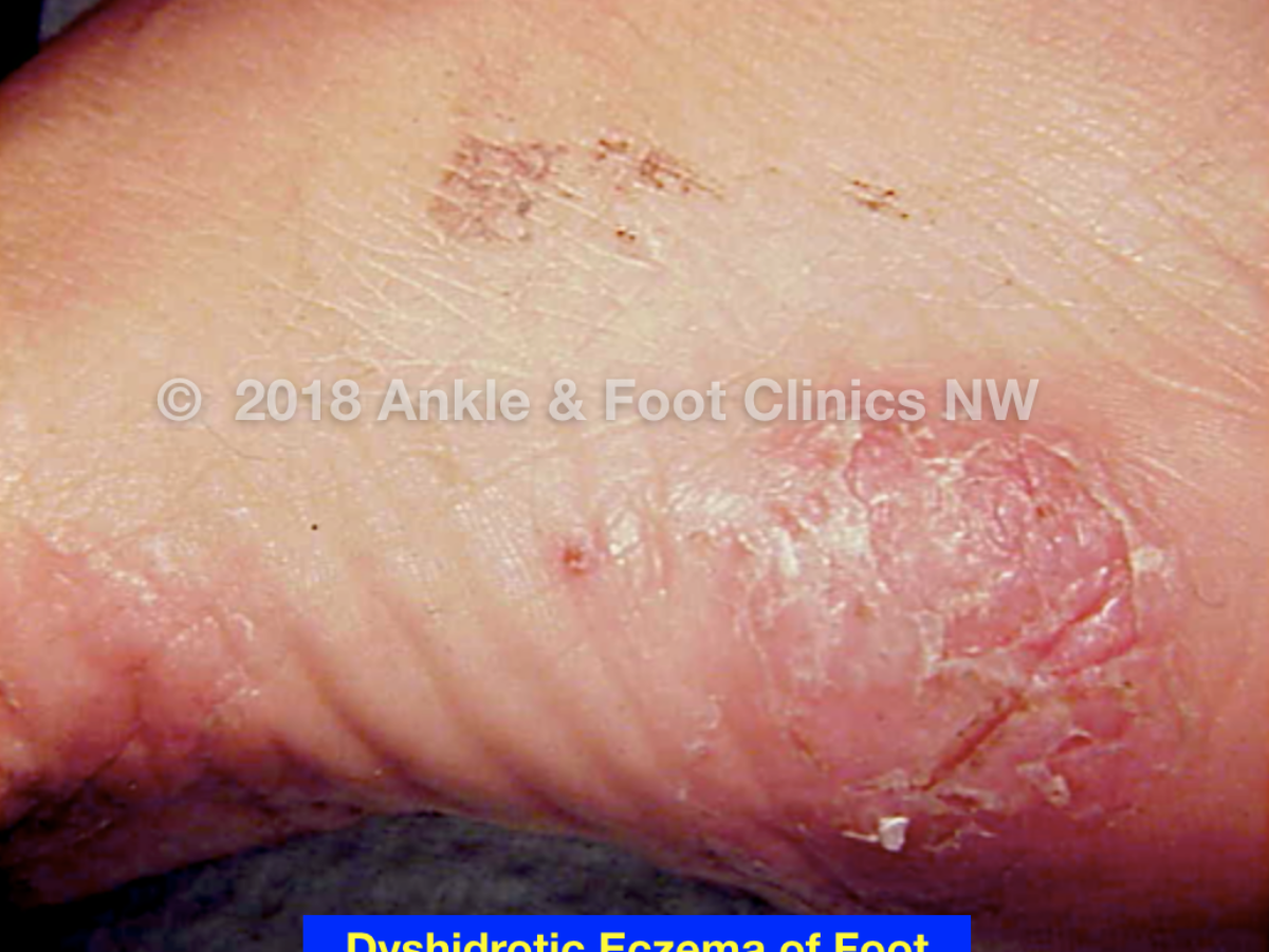Dyshidrotic Eczema Dyshidrotic Eczema: Overview, Causes, Diagnosis
