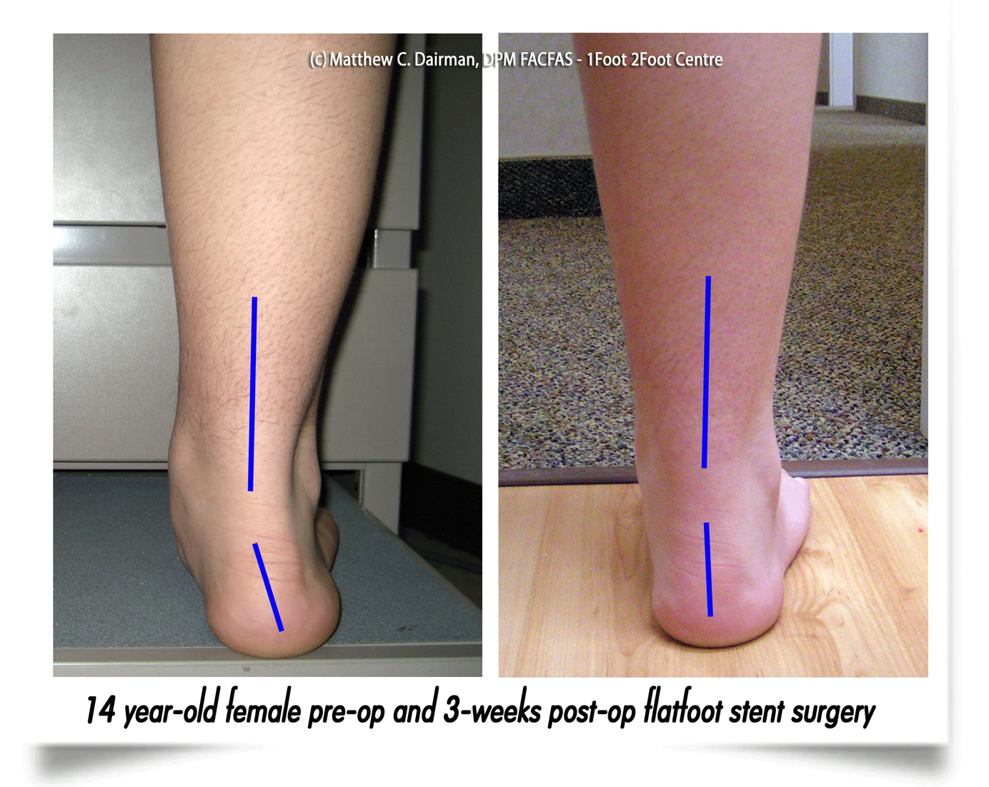 Flat Foot Treatment, Pain Relief | Suffolk, Hampton, Virginia Beach VA