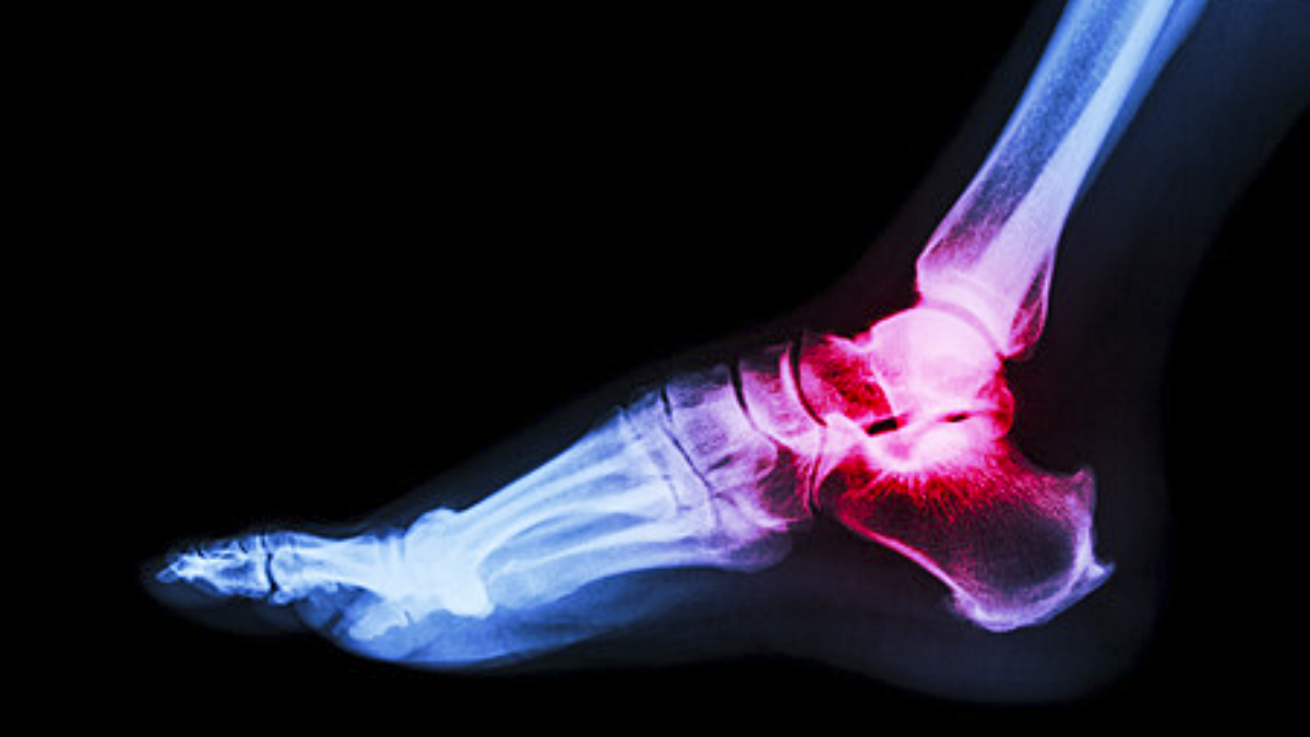 Xray Broken Foot Talus Fractures (foot) New York Fracture Care