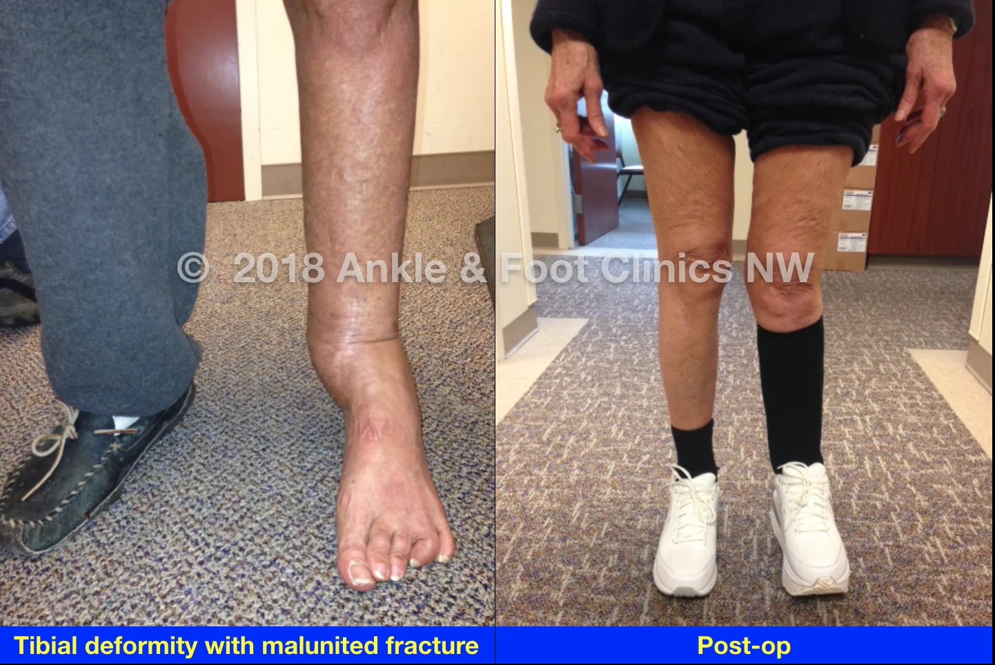 Leg Deformity | Integrative Foot & Ankle Centers of Washington
