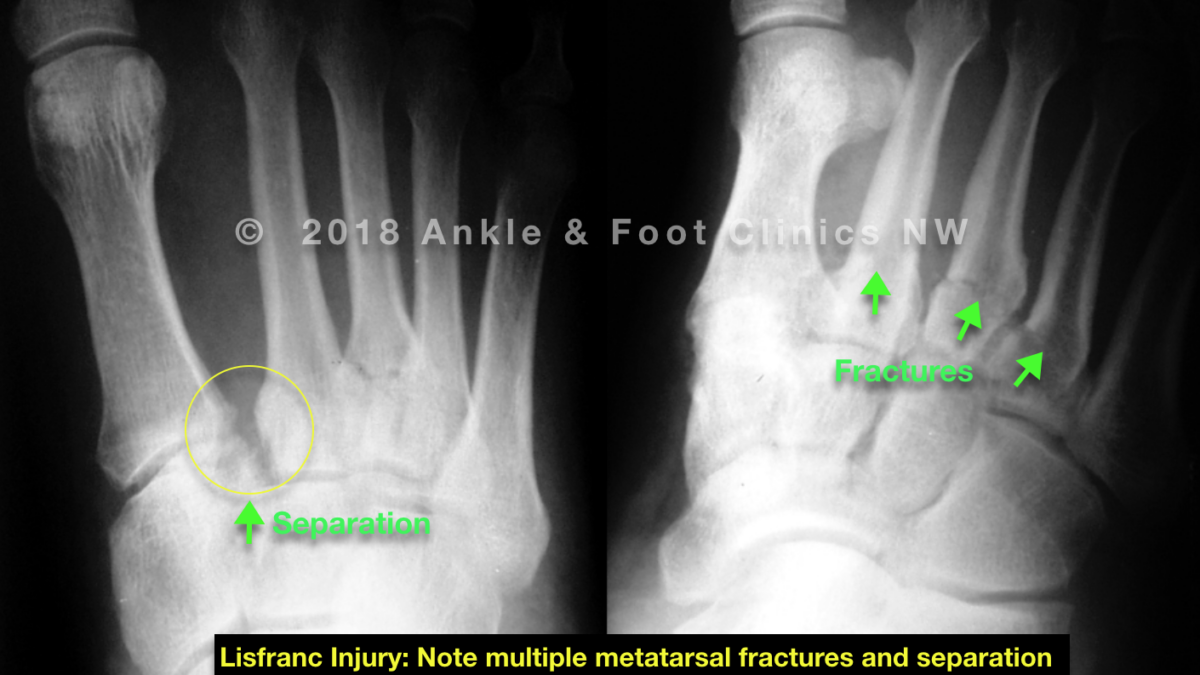 Midfoot Sprain Versus Lisfranc Injury Midfoot Dislocation Fracture