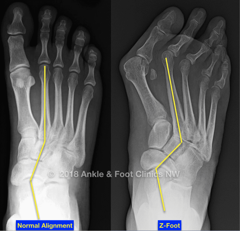 Metatarsus Adductus | Integrative Foot & Ankle Centers of Washington