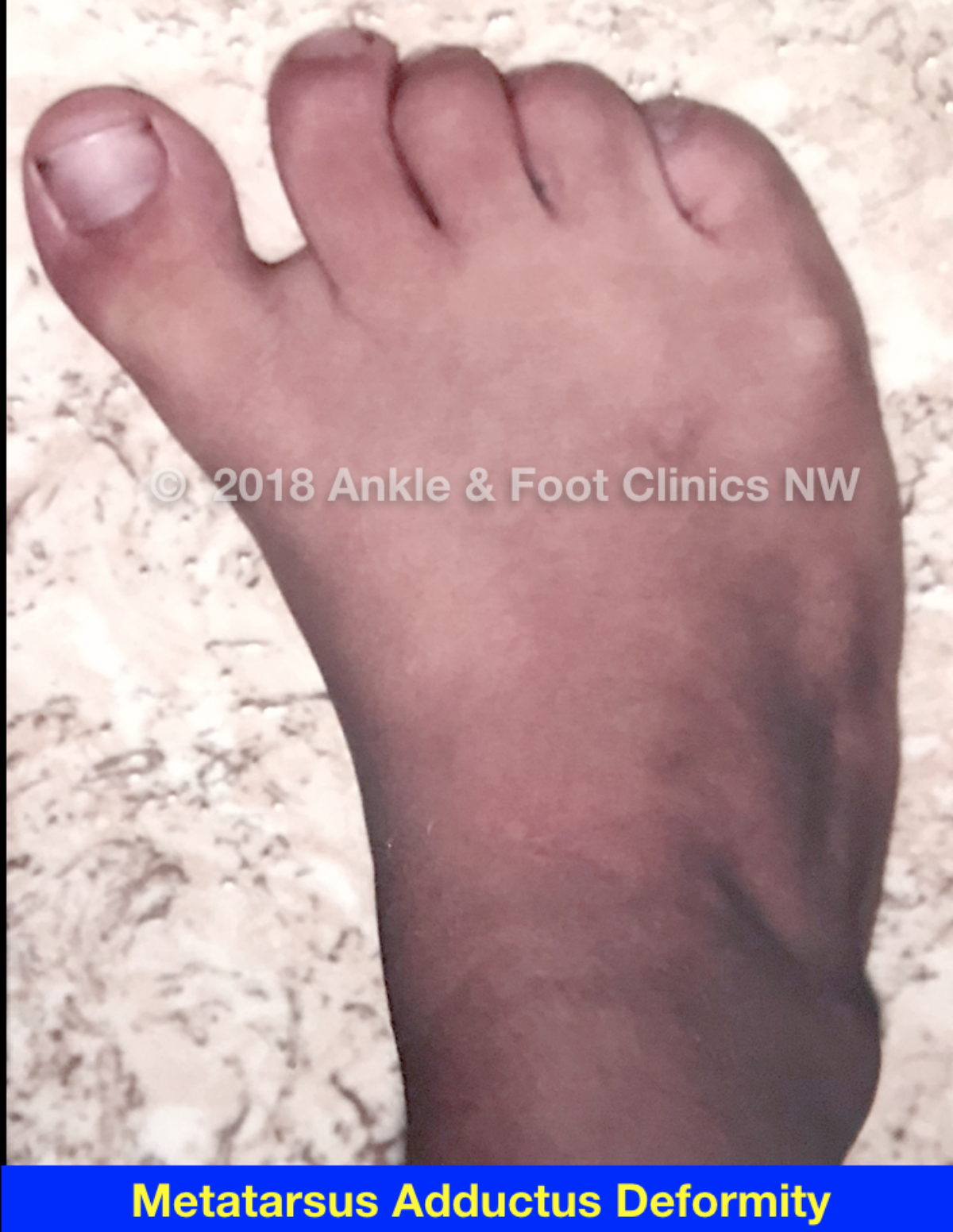 Metatarsus Adductus Metatarsus Varus Or Adductus – KevinRoot Medical