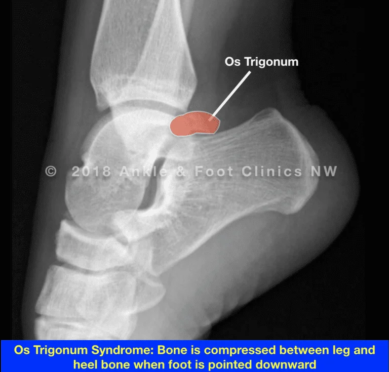 Os Trigonum Syndrome | Integrative Foot & Ankle Centers of Washington