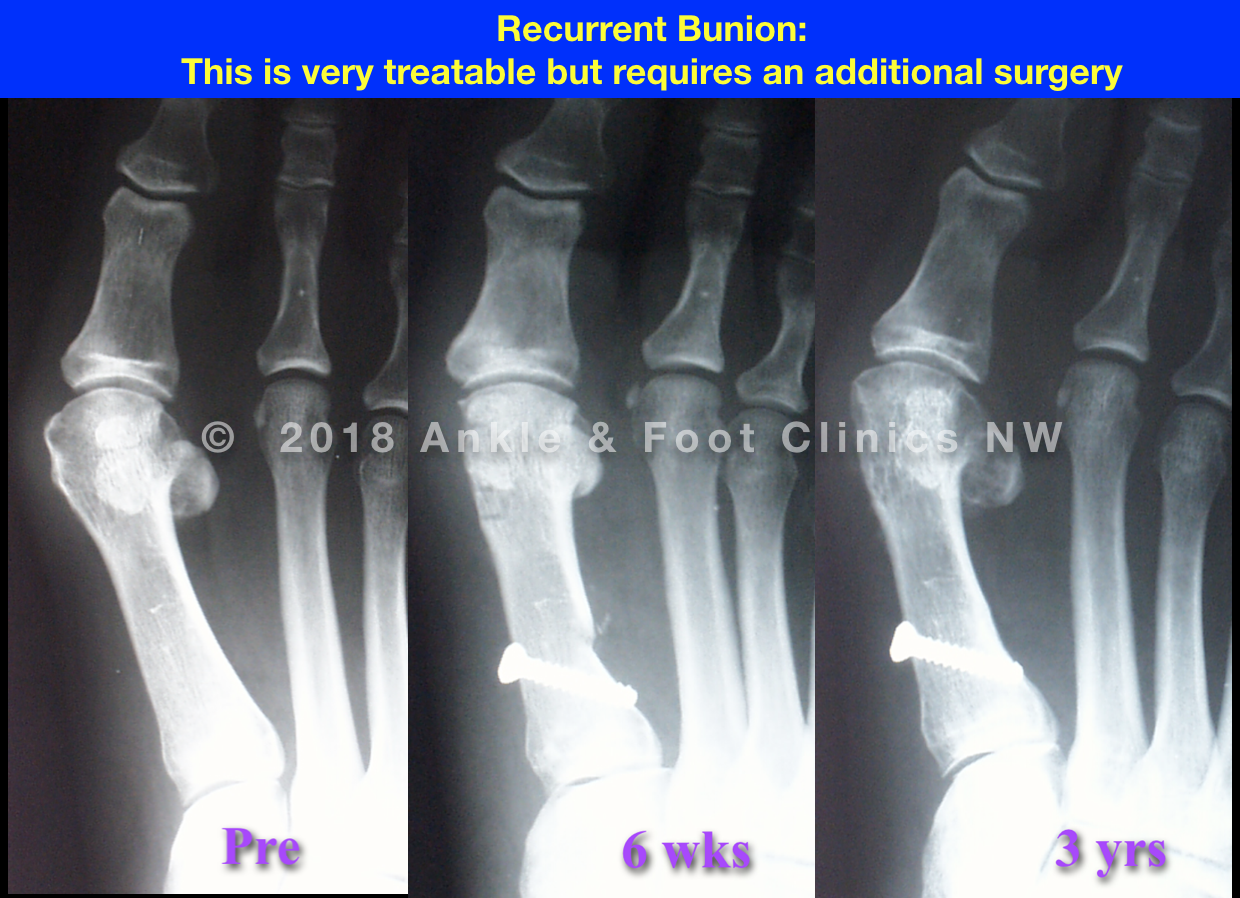 Recurrent Bunions | Integrative Foot & Ankle Centers of Washington