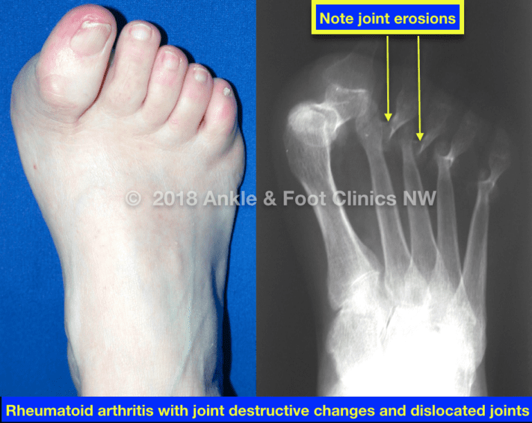 Rheumatoid Foot | Integrative Foot & Ankle Centers of Washington