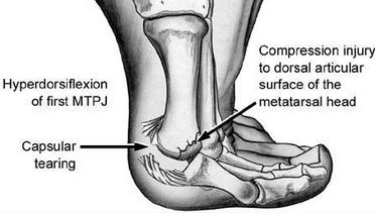 Turf Toe Turf Toe Surgery & Treatment Irvine Orange County Podiatrist