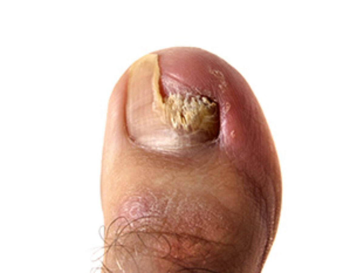 Toenail Infection Fungal Nail Disease | GPonline