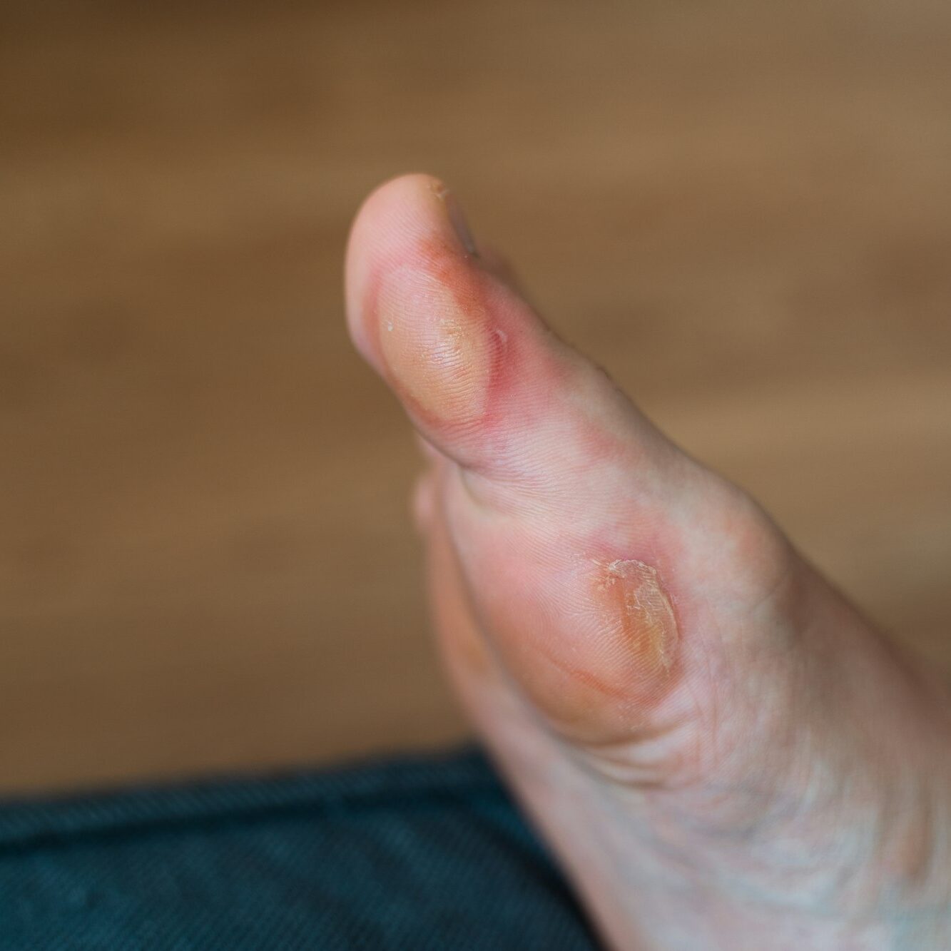 Infected Blister Finger