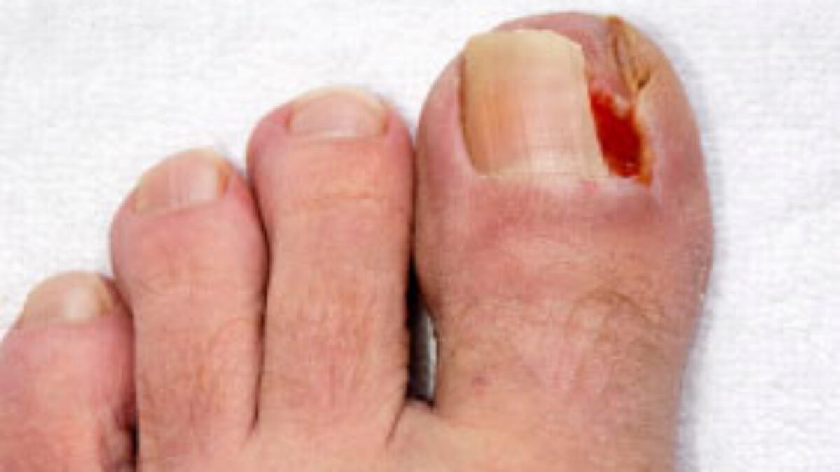 How To Cut Ingrown Toenails New Step Podiatry It Is A Myth! The