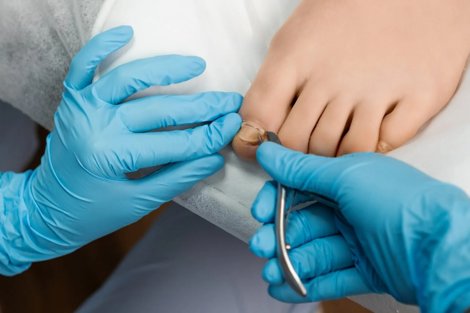 Ingrown Toenails | Definition and Treatment Options