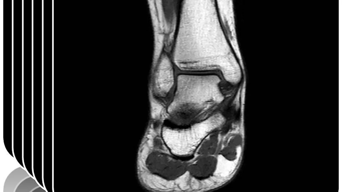 Mri Plantar Wart National Foot & Ankle Review – The Academic Journal