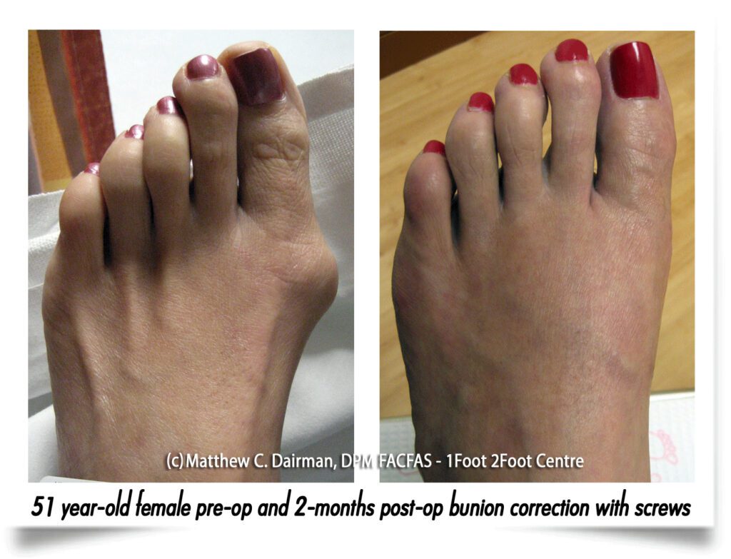 Bunion Treatment and Pain Relief | Suffolk, Hampton, Virginia Beach VA