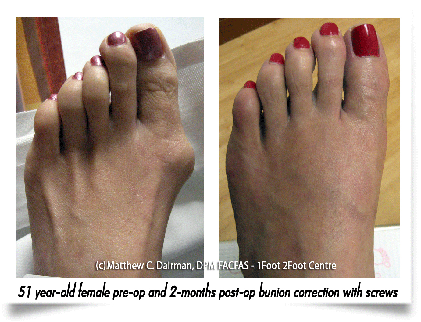 Bunion Treatment and Pain Relief | Suffolk, Hampton, Virginia Beach VA