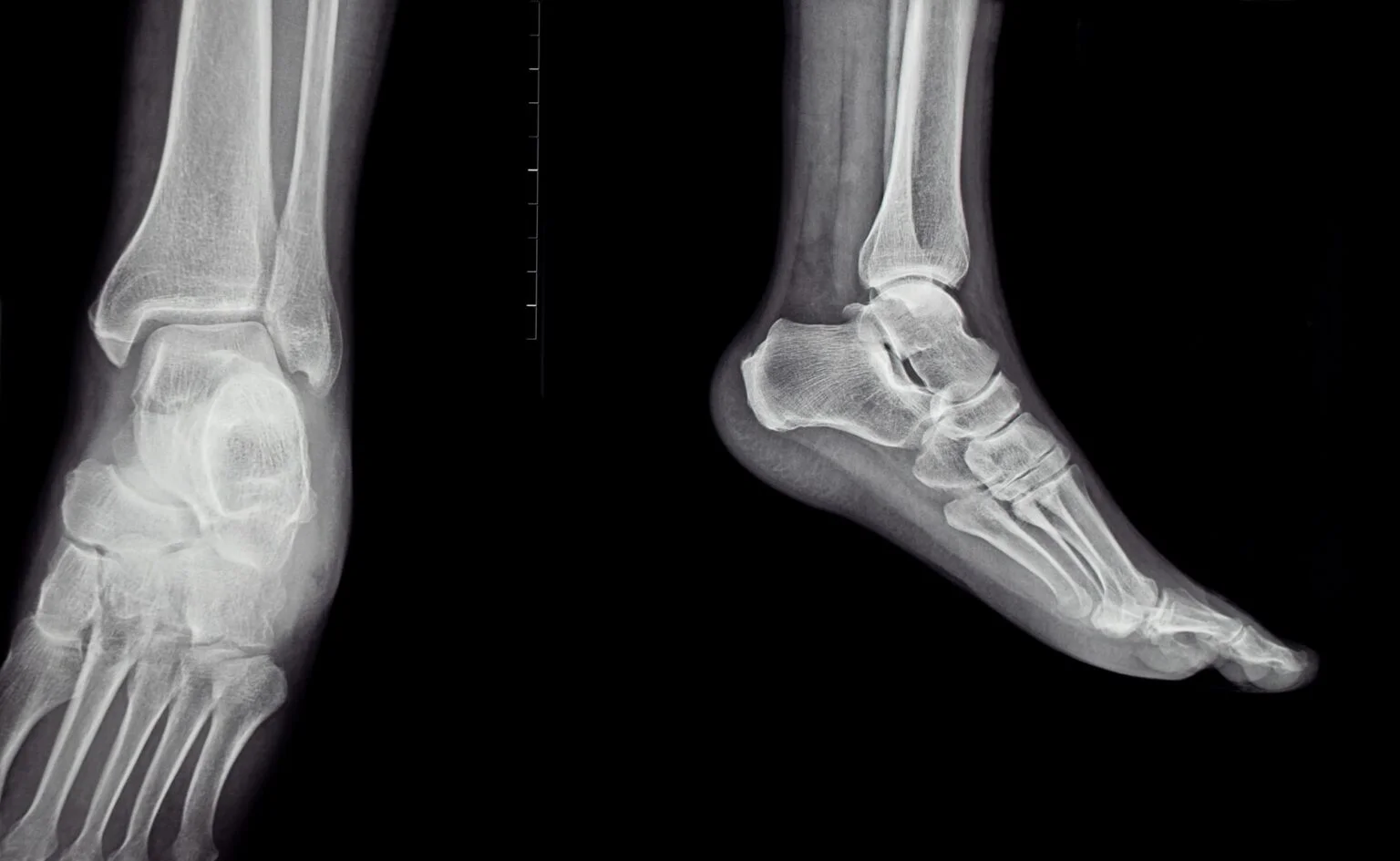 Brachymetatarsia | University Foot & Ankle Institute
